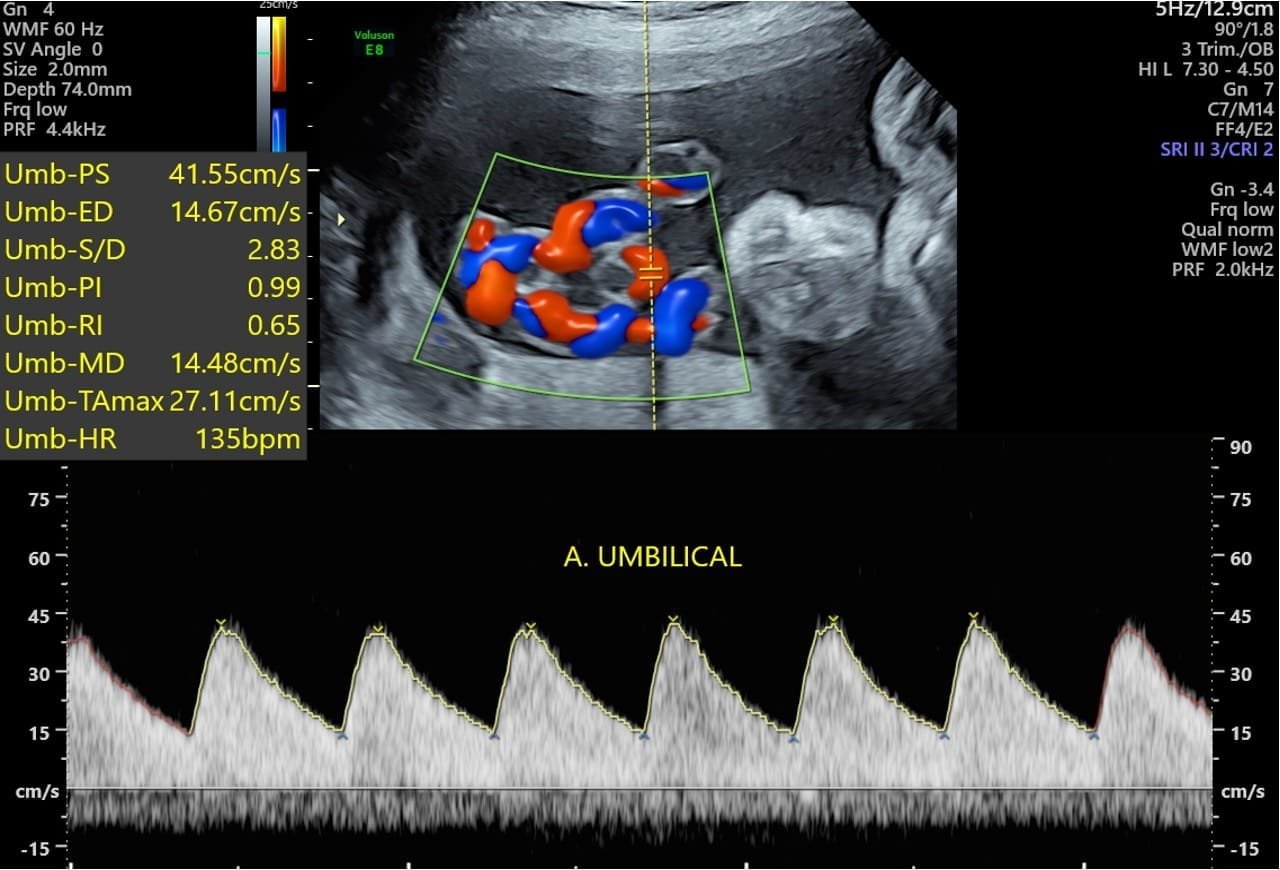 Ultrassonografia Da Arteria Umbilical O Cordão Umbilical é